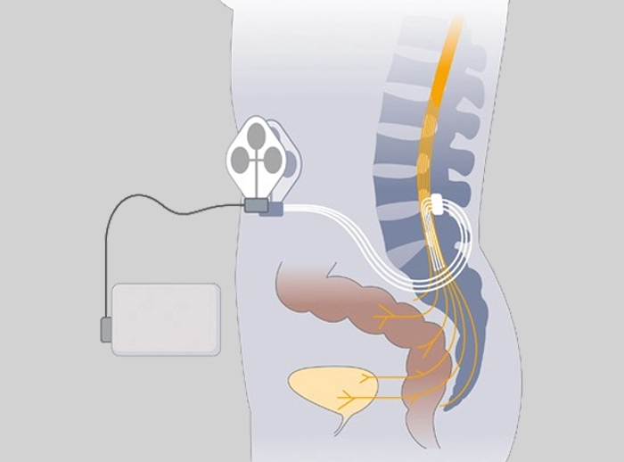 Improved Quality of Life with Sacral Nerve Stimulation | IBS Hospital
